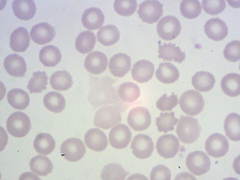 Hematologia – Hemácias Crenadas(Equinócitos) – Laboratório Alvim